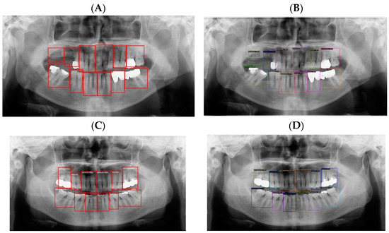 Automated Detection of Periodontal Bone Loss Using Deep Learning and Panoramic Radiographs: A ...