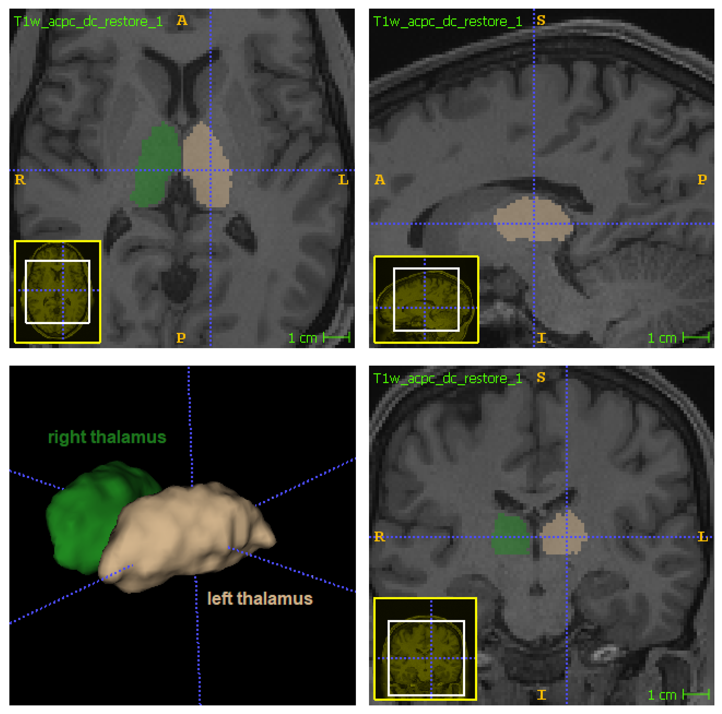 Thalamus Segmentation Using Deep Learning with Diffusion MRI Data: An Open Benchmark