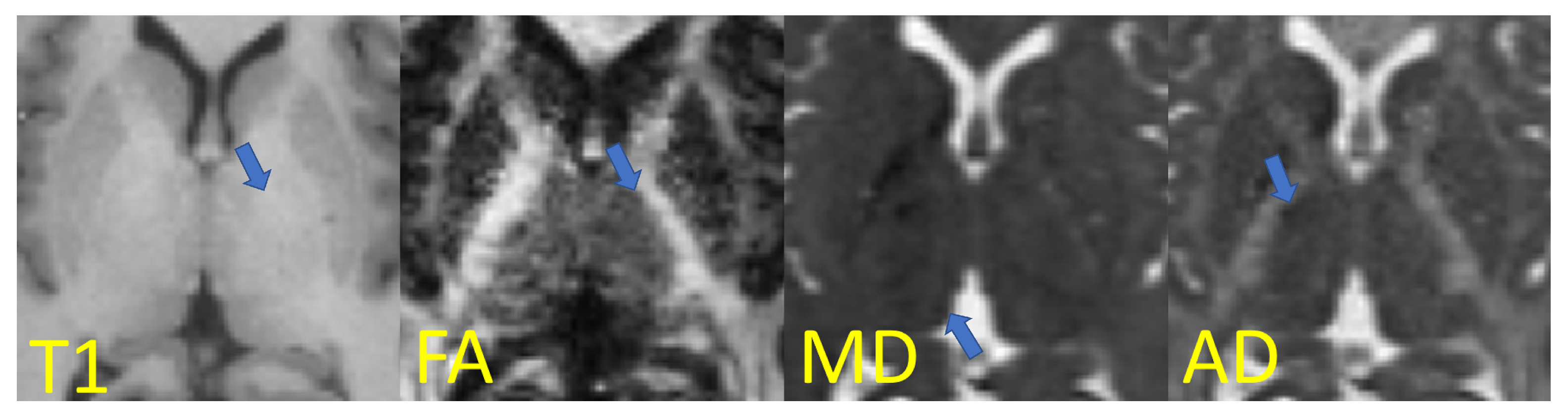 Thalamus Segmentation Using Deep Learning with Diffusion MRI Data: An ...