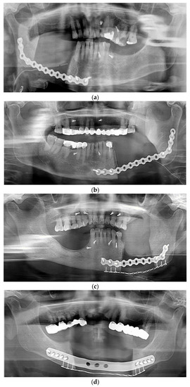 Spontaneous Osteogenic Potential of Periosteum after Segmental ...