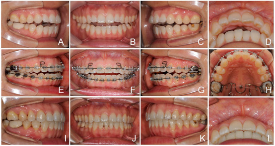 Open-Bite Correction Using a Mid-Palatal TAD with an Intrusion TPA ...