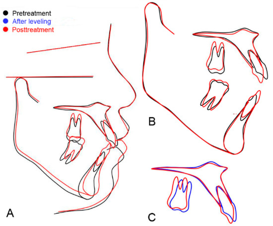 Open-Bite Correction Using a Mid-Palatal TAD with an Intrusion TPA ...
