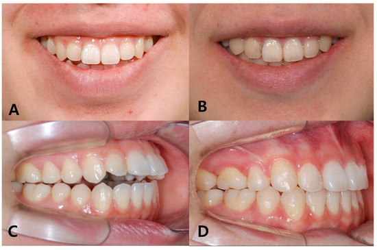 Open-Bite Correction Using a Mid-Palatal TAD with an Intrusion TPA ...