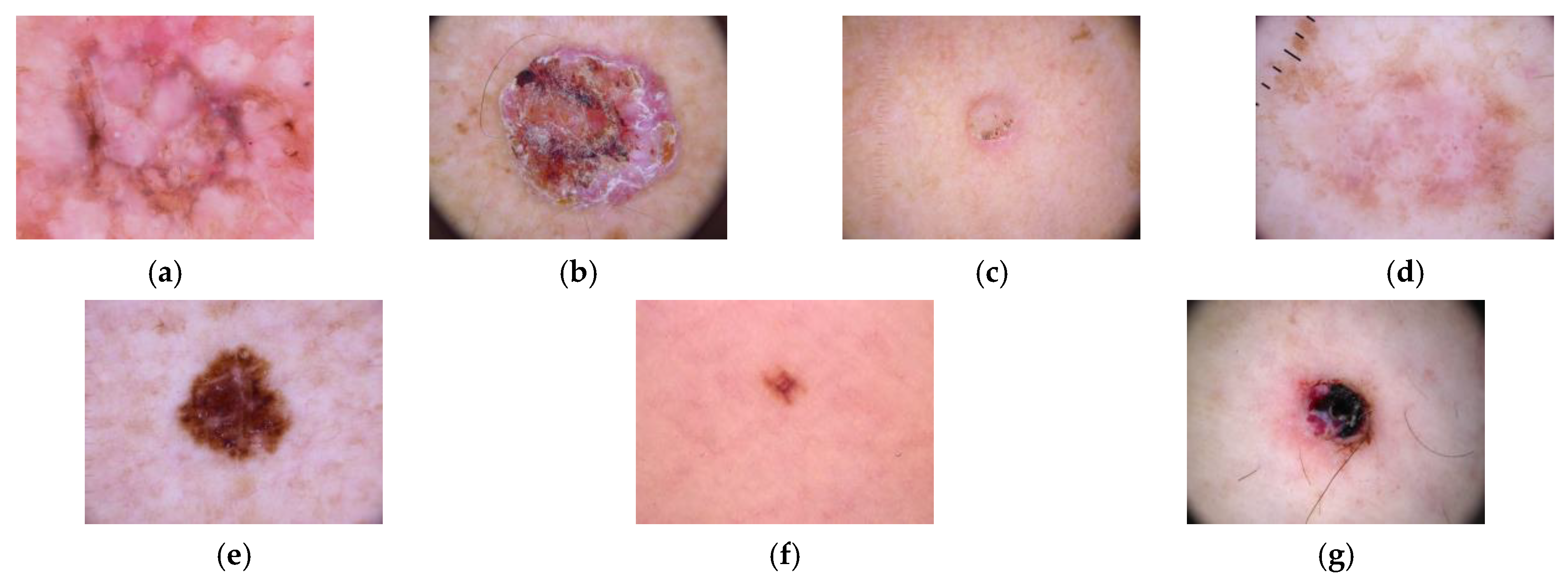 Skin Lesion Classification Of Dermoscopic Images Using 43 Off