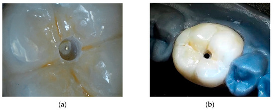 Guided Access through Ceramic Crowns with Fiberglass Post Removal in ...