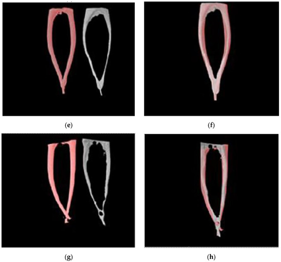 Effect of Traditional and Conservative Endodontic Access Cavities on ...