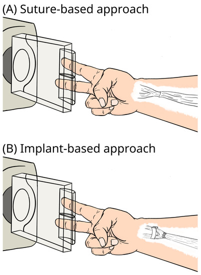 Applied Sciences | Free Full-Text | A Novel Passive Implantable ...