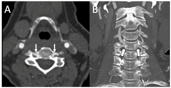 Applied Sciences | Free Full-Text | Radiological Assessment of Extracranial Vertebral Artery ...