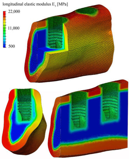 Interaction Phenomena between Dental Implants and Bone Tissue in Case ...