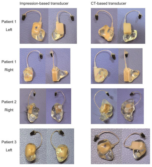 Comparison of Cartilage Conduction Hearing Devices Designed by Ear ...