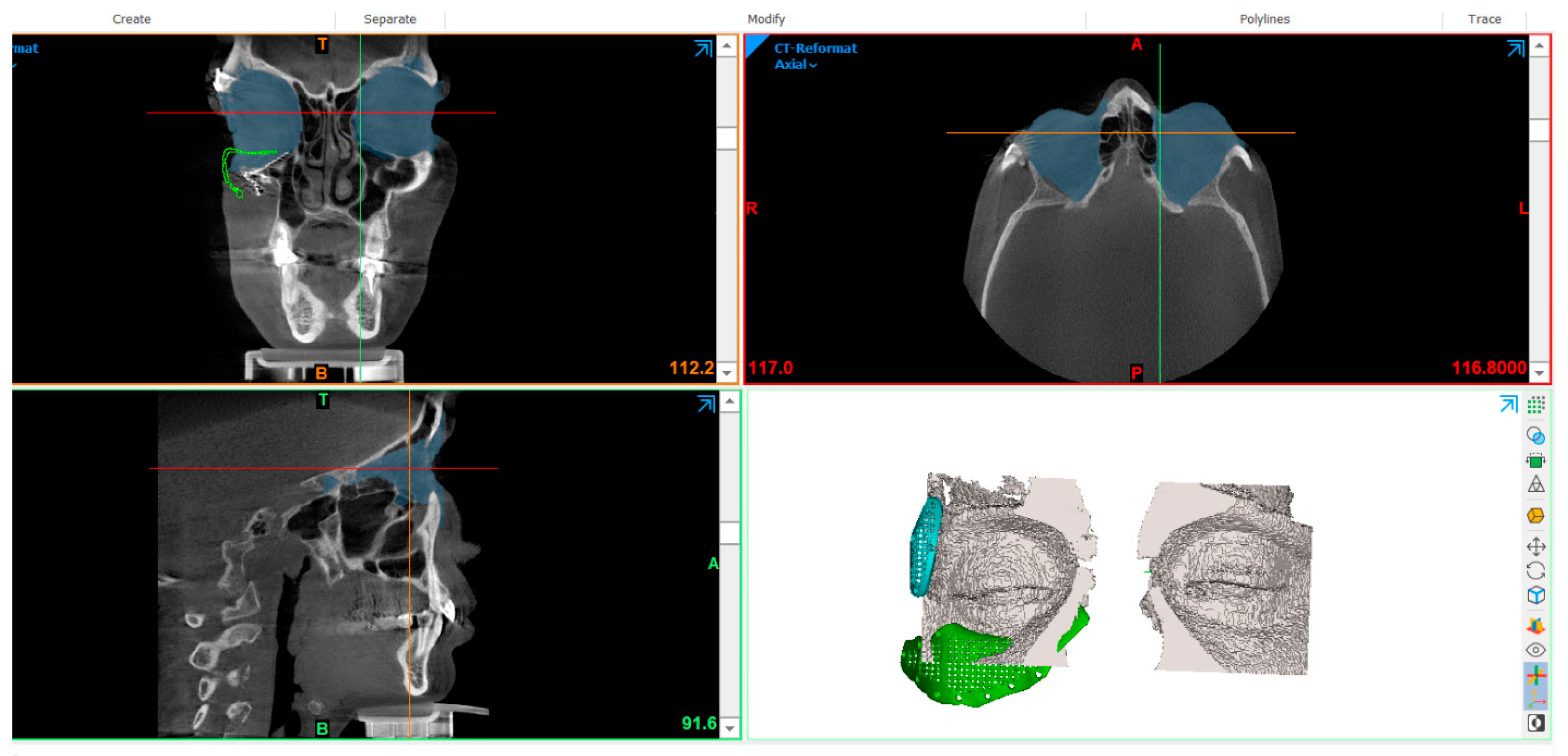 Applied Sciences | Free Full-Text | A Case Report of Zygomatic Fracture Reconstruction ...