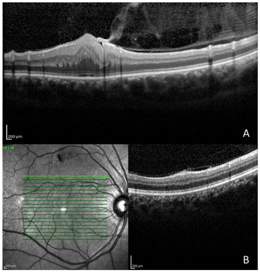Ophthalmic Manifestation in Neurofibromatosis Type 2