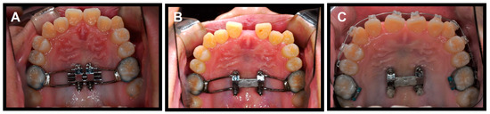 Treatment Effects of Miniscrew-Assisted Rapid Palatal Expansion in ...