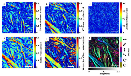 Distinguishing Malignant Melanoma and Benign Nevus of Human Skin by ...