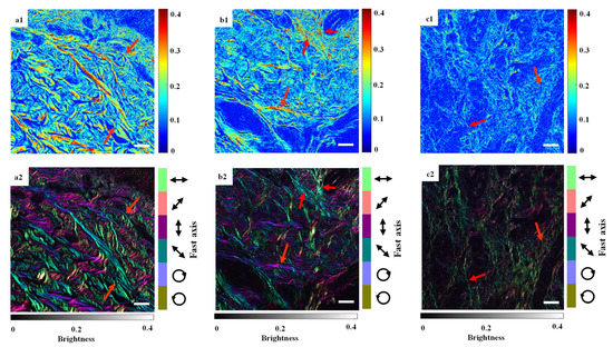 Distinguishing Malignant Melanoma and Benign Nevus of Human Skin by ...