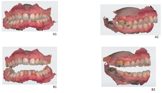 Proposal of a Full Digital Workflow for a Bite Fork to Assess ...