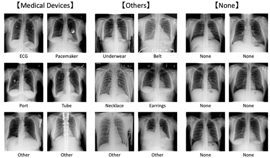 Development of Chest X-ray Image Evaluation Software Using the Deep ...
