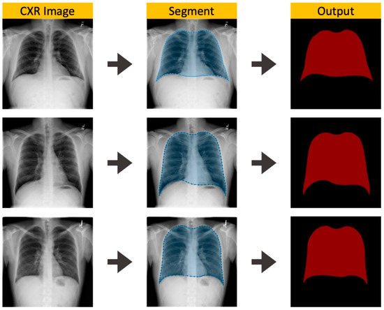 Development of Chest X-ray Image Evaluation Software Using the Deep ...