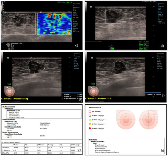 Can New Ultrasound Imaging Techniques Improve Breast Lesion Characterization? Prospective ...