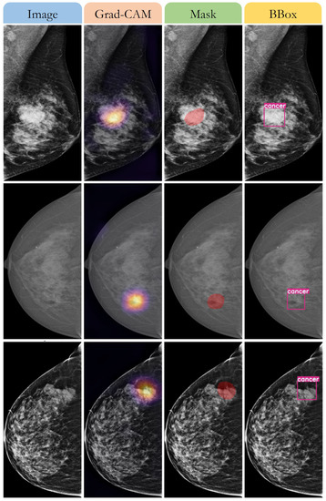 Region-of-Interest Optimization for Deep-Learning-Based Breast Cancer ...