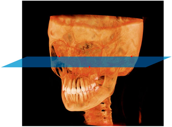Factors Associated with the Proximity of the Incisive Canal to the ...