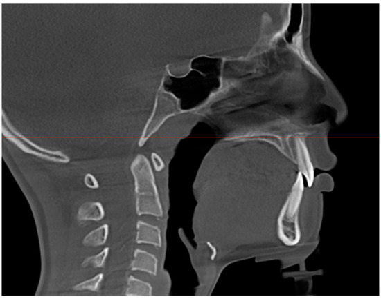 Factors Associated with the Proximity of the Incisive Canal to the ...