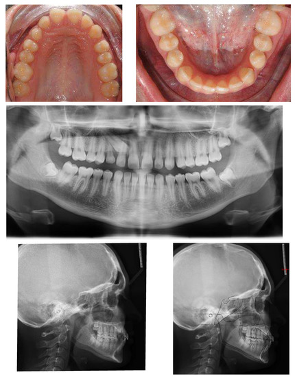 Canine Impaction: Digital Orthodontic Planning in Conjunction with TADs ...
