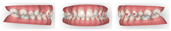 Canine Impaction: Digital Orthodontic Planning in Conjunction with TADs ...