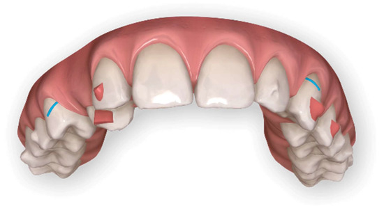 Canine Impaction: Digital Orthodontic Planning in Conjunction with TADs ...