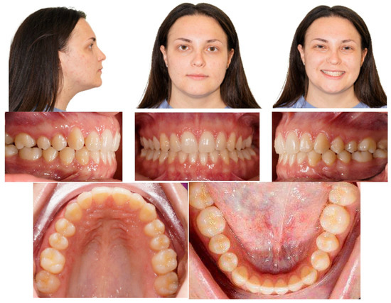 Canine Impaction: Digital Orthodontic Planning in Conjunction with TADs ...