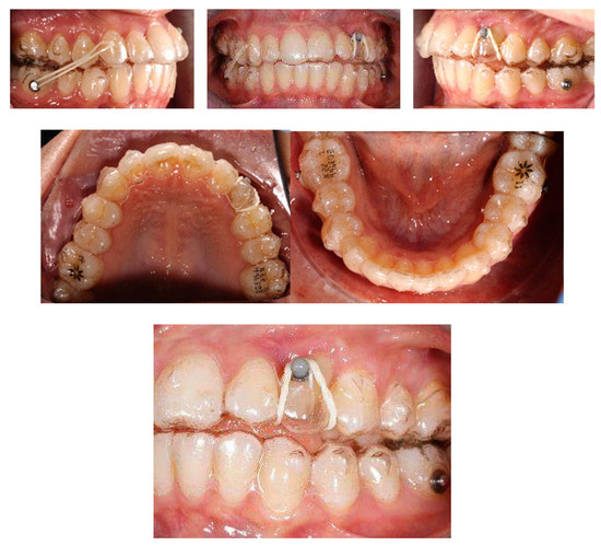 Canine Impaction: Digital Orthodontic Planning in Conjunction with TADs ...