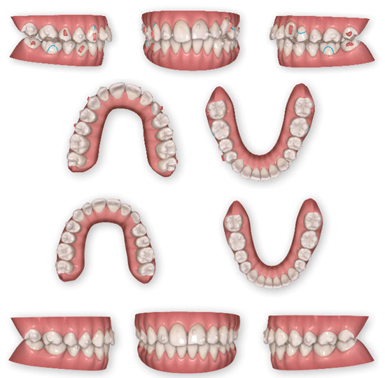 Canine Impaction: Digital Orthodontic Planning in Conjunction with TADs ...