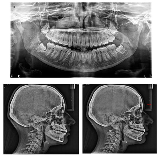 Canine Impaction: Digital Orthodontic Planning in Conjunction with TADs ...