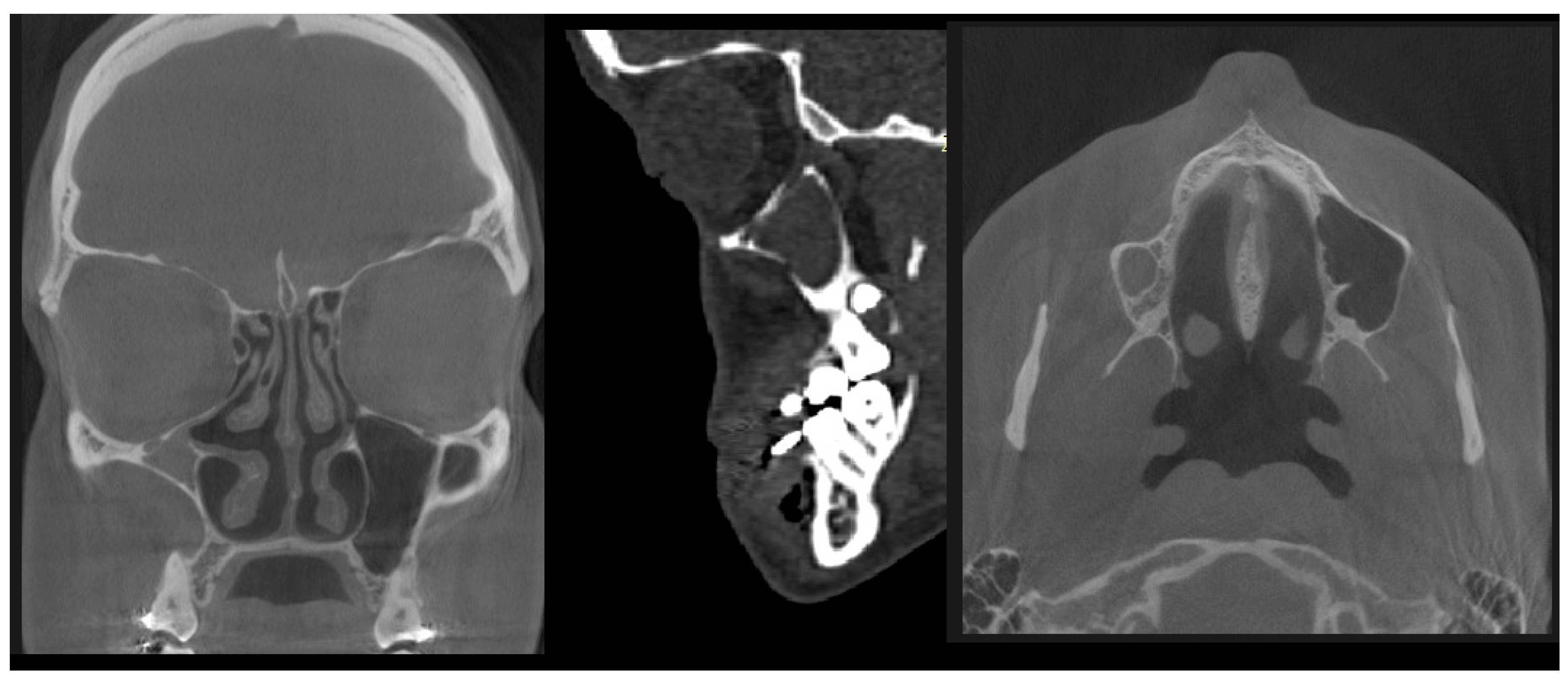 A Retrospective Study on Silent Sinus Syndrome in Cone Beam-Computed Tomography Images—Author ...