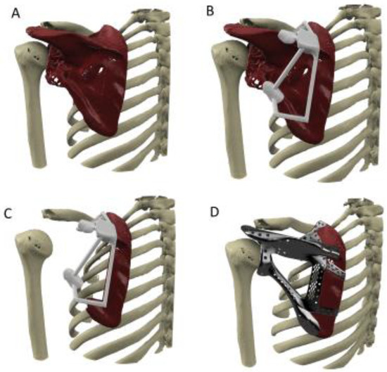 Three-Dimensional Printed Custom-Made Prostheses after Partial ...