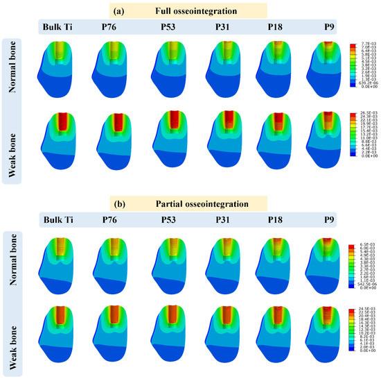 Biomechanical Investigation of Patient-Specific Porous Dental Implants ...