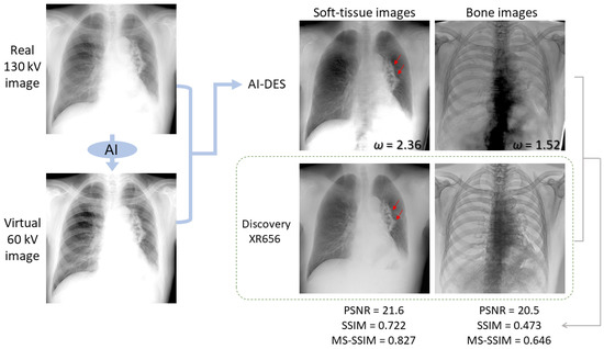 Development of Artificial Intelligence-Based Dual-Energy Subtraction ...