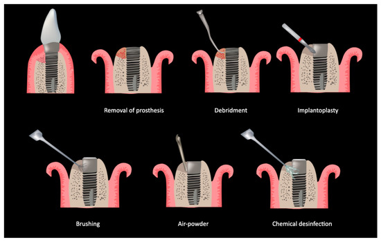 Absence of Progressive Bone Loss Following Peri-Implantitis Surgical ...