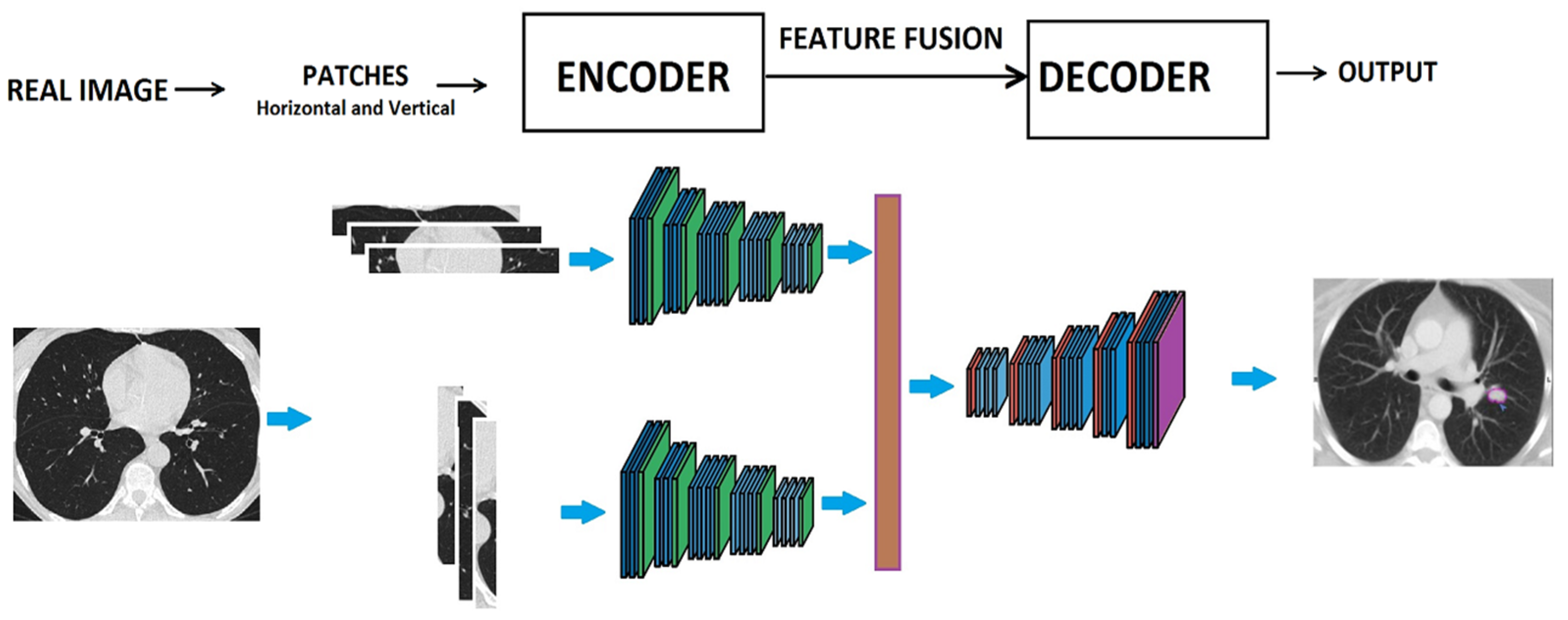 Improved Segmentation of Pulmonary Nodules Using Soft Computing Techniques with SegNet and ...
