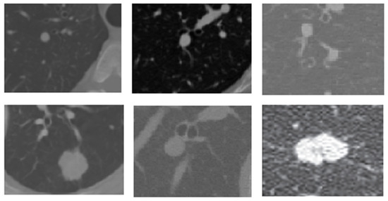 Improved Segmentation of Pulmonary Nodules Using Soft Computing ...