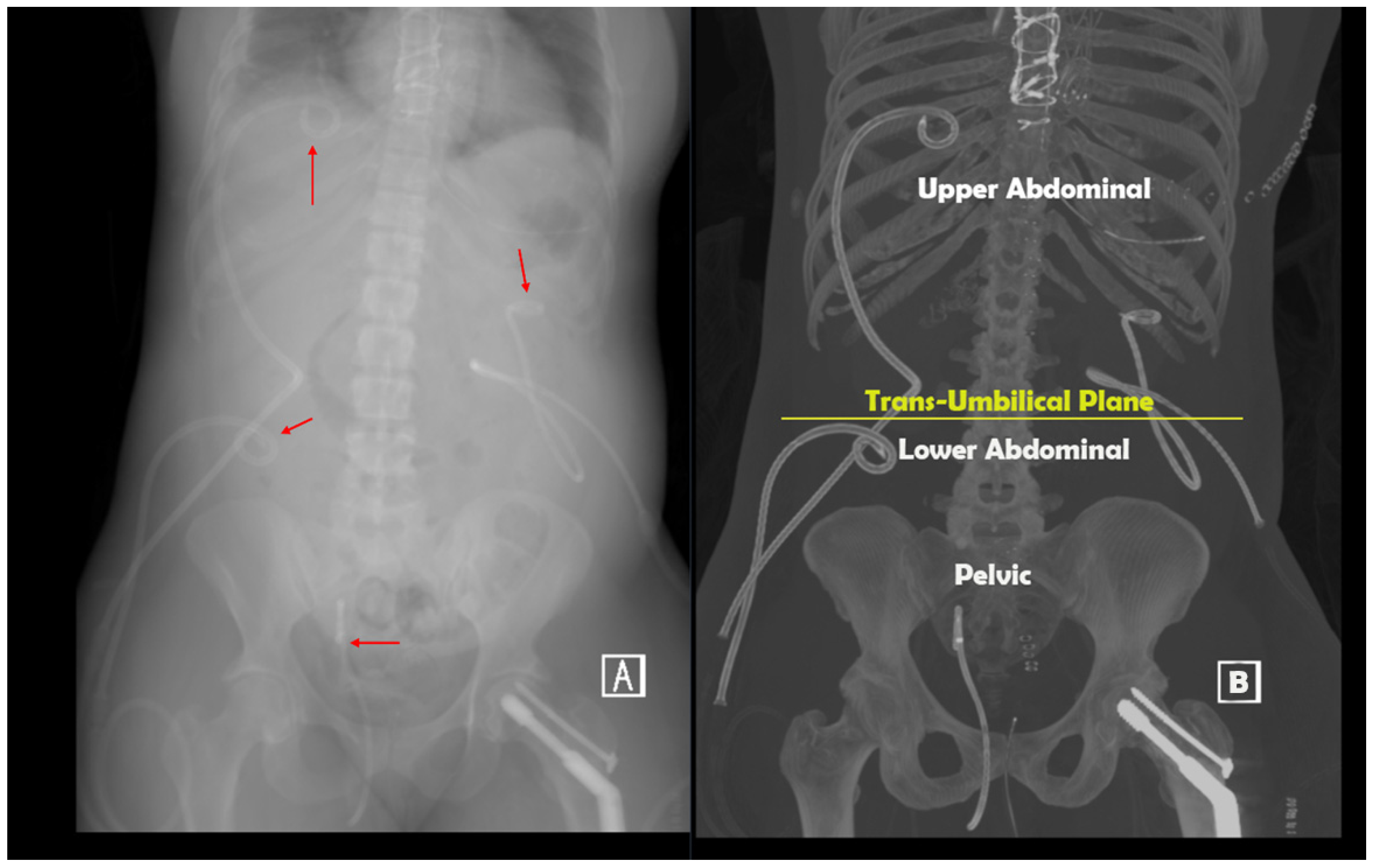 Pilot Study on the Influence of Incentive Spirometry on Percutaneous Image-Guided Intra ...