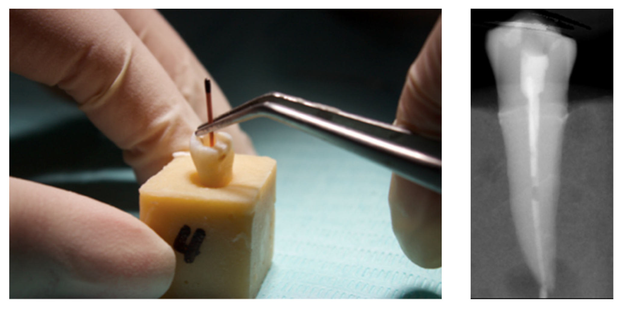 Assessment of Penetrability for Different Endodontic Irrigation ...