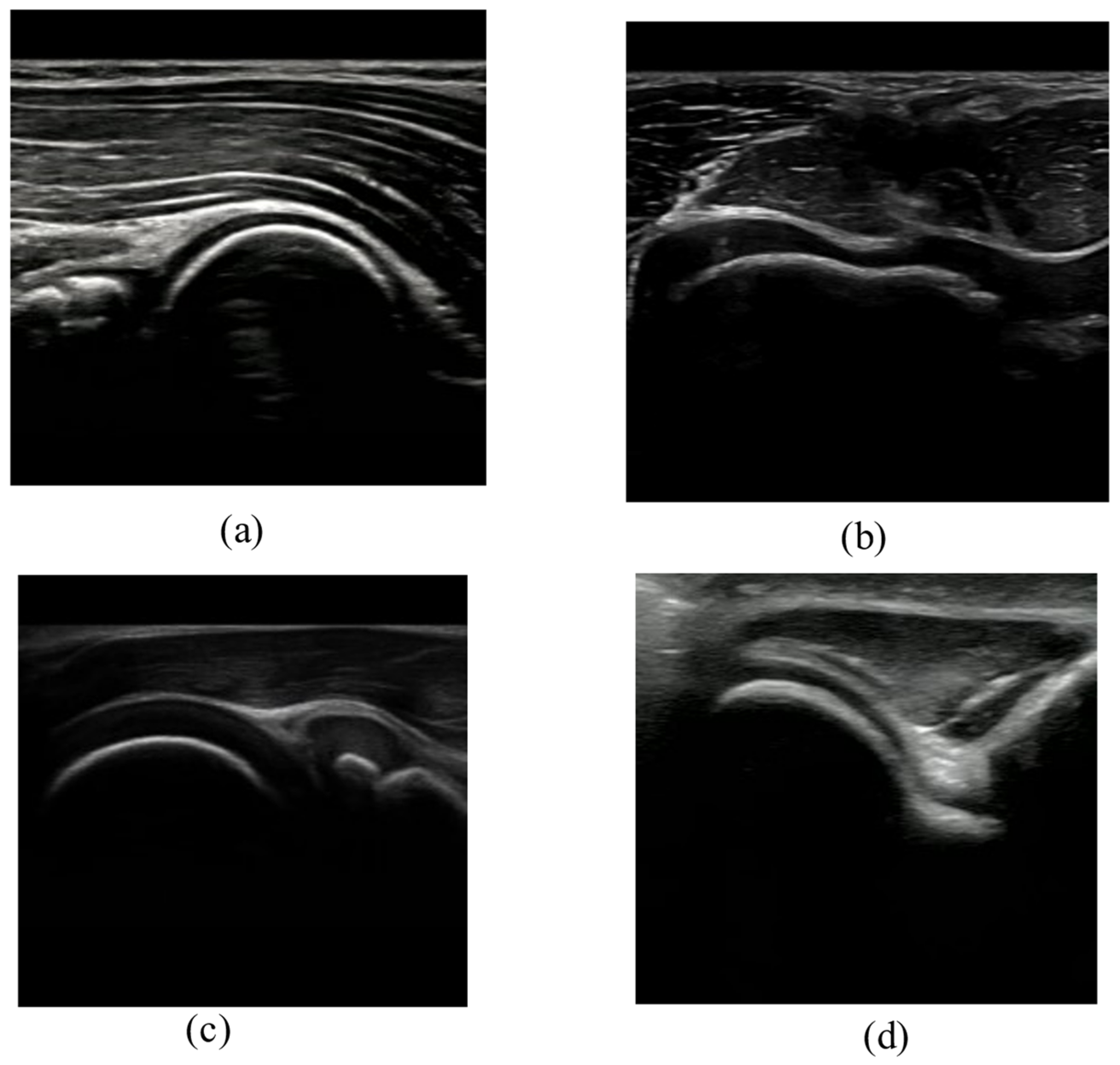 Detection of Elbow OCD in the Ultrasound Image by Artificial ...