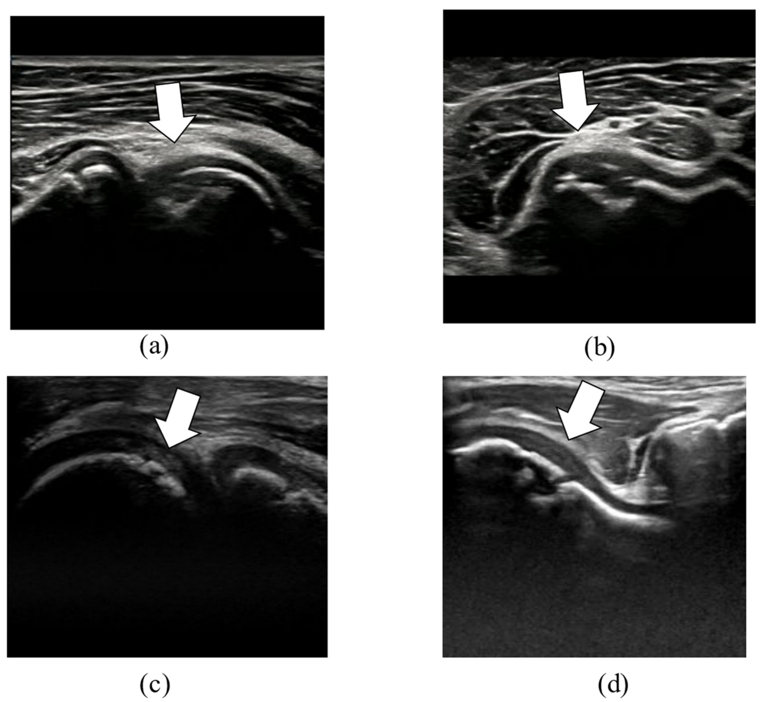 Detection of Elbow OCD in the Ultrasound Image by Artificial ...