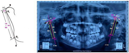 An Evaluation of the Ramus Mandibular Asymmetry on the Panoramic ...