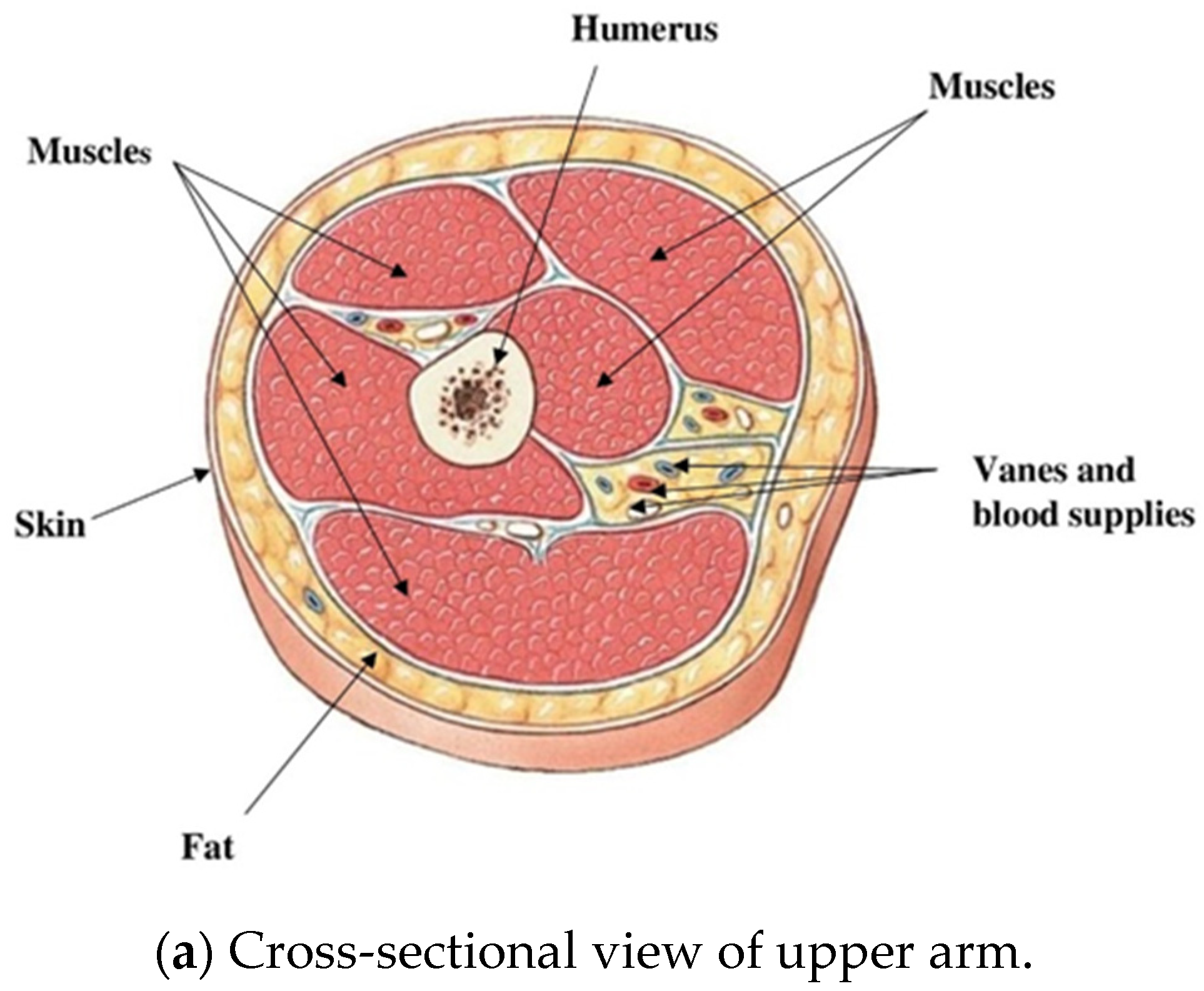 Monitoring of Surgically Treated Upper Arm Fracture by Implanted ...