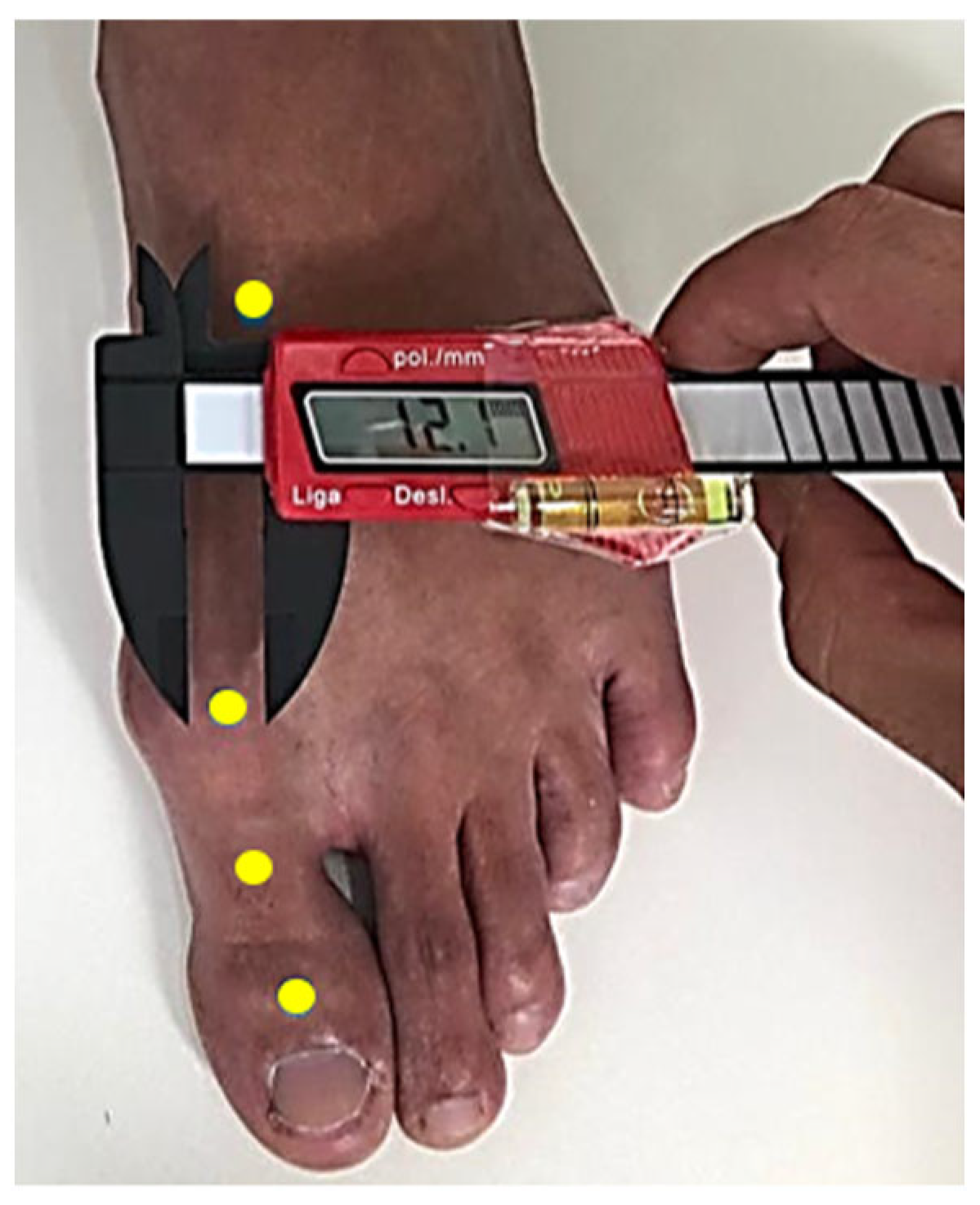 A Pathway to Hallux Valgus Correction: Intra- and Interexaminer ...