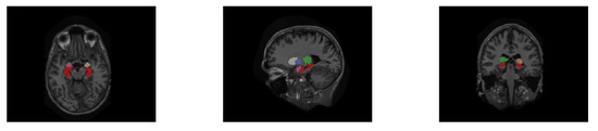 Hippocampus Segmentation Method Applying Coordinate Attention Mechanism and Dynamic Convolution ...