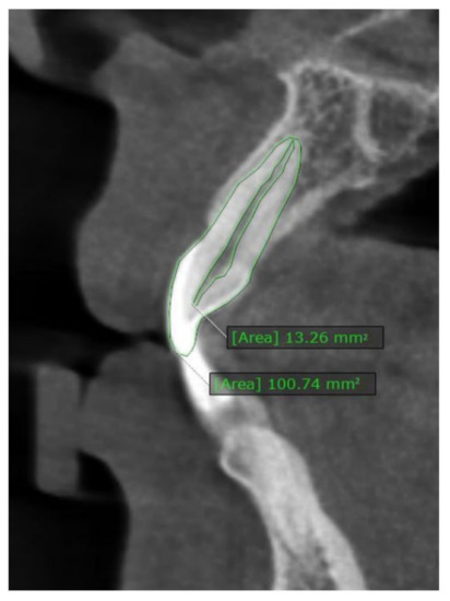 Relationship between Pulp–Tooth Area Ratio and Chronological Age among ...