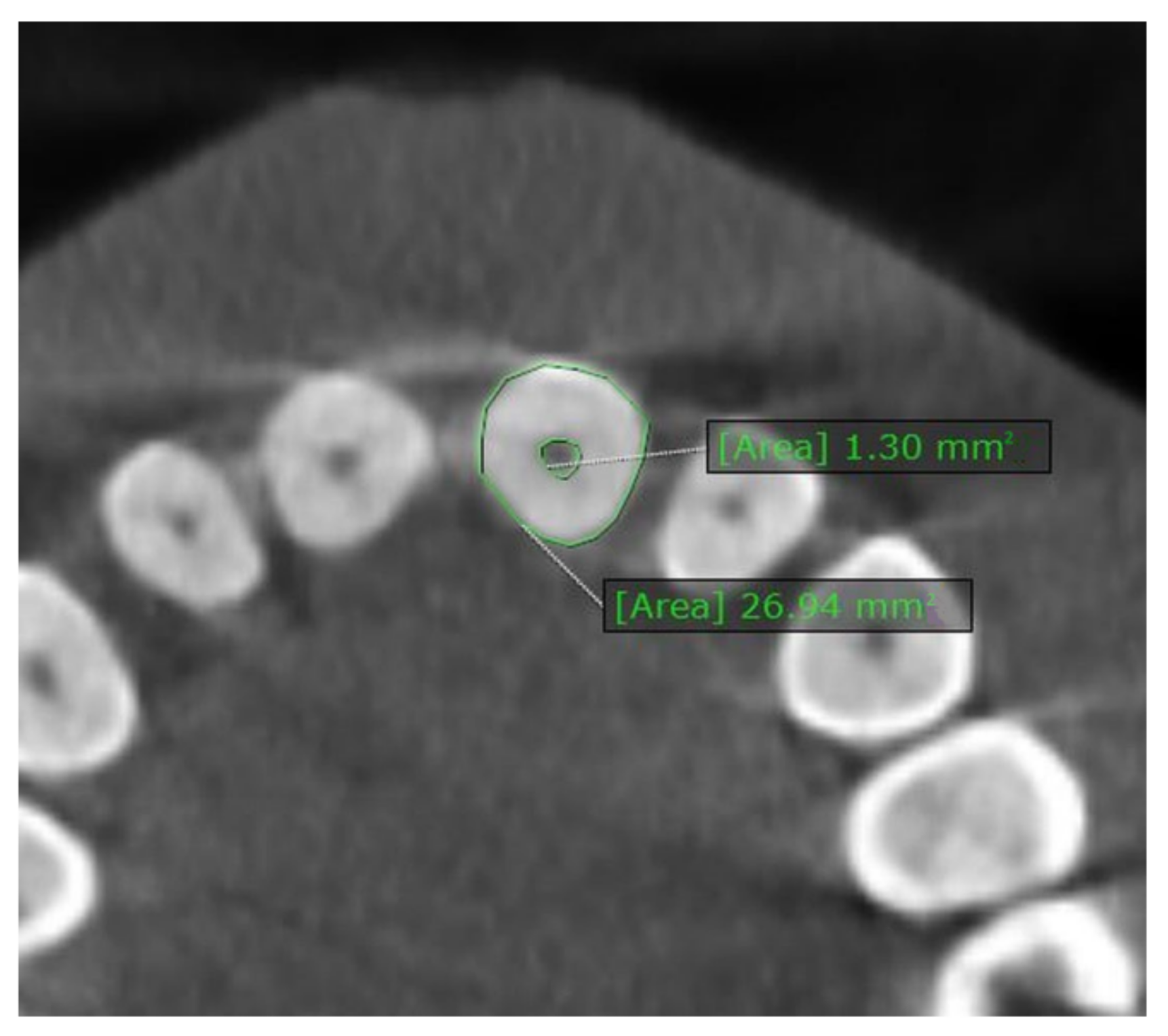 Relationship between Pulp–Tooth Area Ratio and Chronological Age among ...